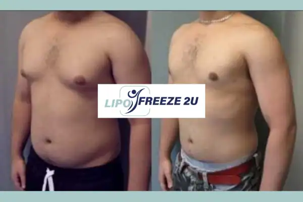 Fat Freezing Treatment Bedfordshire Non-Surgical Fat Reduction