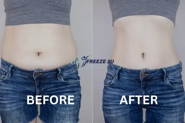 Fat Freezing Treatment Bedfordshire Non-Surgical Fat Reduction